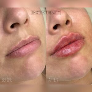 Russian Lip Technique - Lip Augmentation, Lip Filler NYC