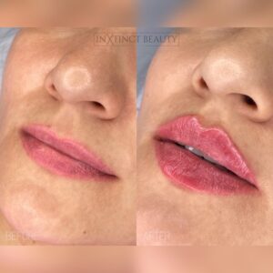 Russian Lip Technique - Lip Augmentation, Lip Filler NYC