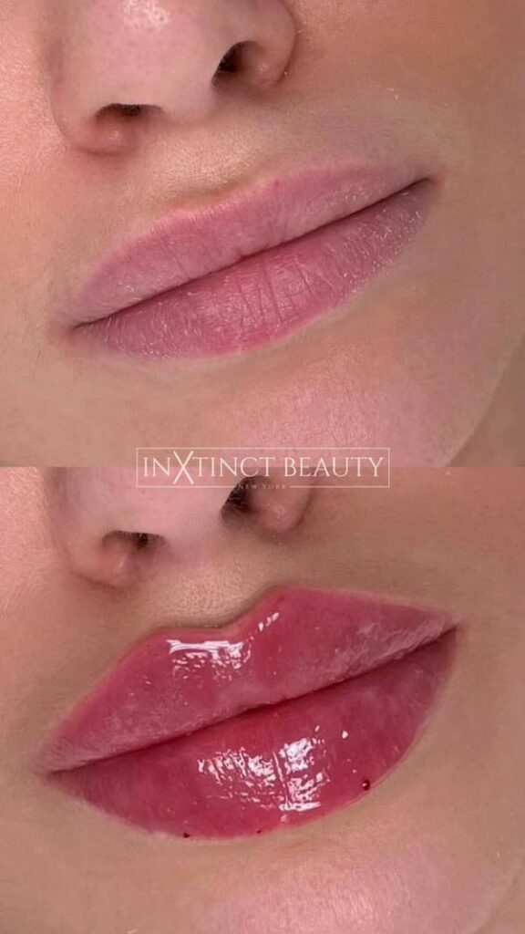 Russian Lip Technique - Lip Augmentation, Lip Filler NYC