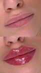 Russian Lip Technique - Lip Augmentation, Lip Filler NYC
