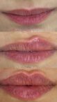 Russian Lip Technique - Lip Augmentation, Lip Filler NYC