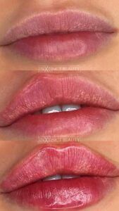 Russian Lip Technique - Lip Augmentation, Lip Filler NYC