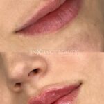 Russian Lip Technique - Lip Augmentation, Lip Filler NYC