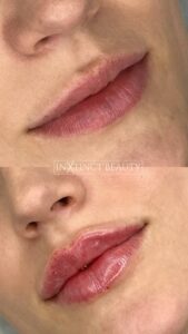 Russian Lip Technique - Lip Augmentation, Lip Filler NYC
