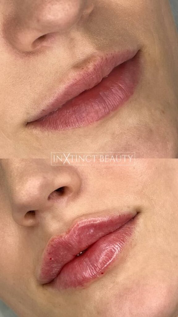 Russian Lip Technique - Lip Augmentation, Lip Filler NYC