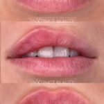 Russian Lip Technique - Lip Augmentation, Lip Filler NYC