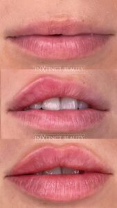 Russian Lip Technique - Lip Augmentation, Lip Filler NYC
